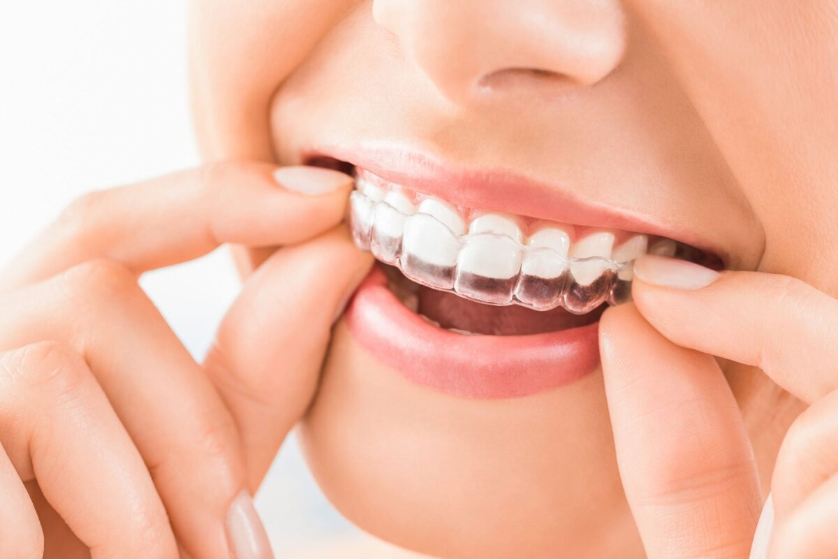 Certified Invisalign® Provider in Arlington, VA | RNX Dental
